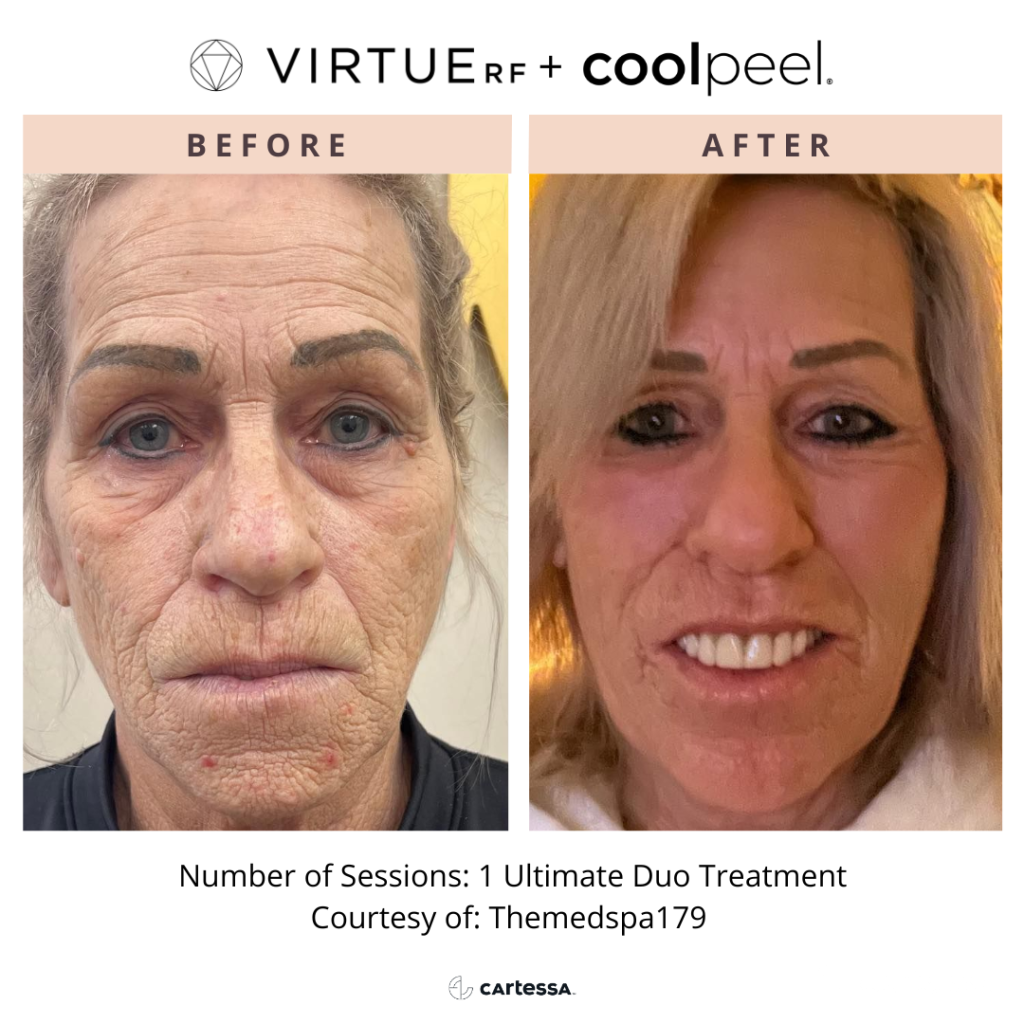 Advanced Laser Treatments | Vitality Antiaging Hickory NC