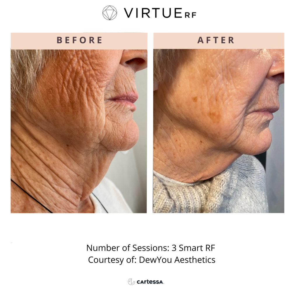 Advanced Laser Treatments | Vitality Antiaging Hickory NC