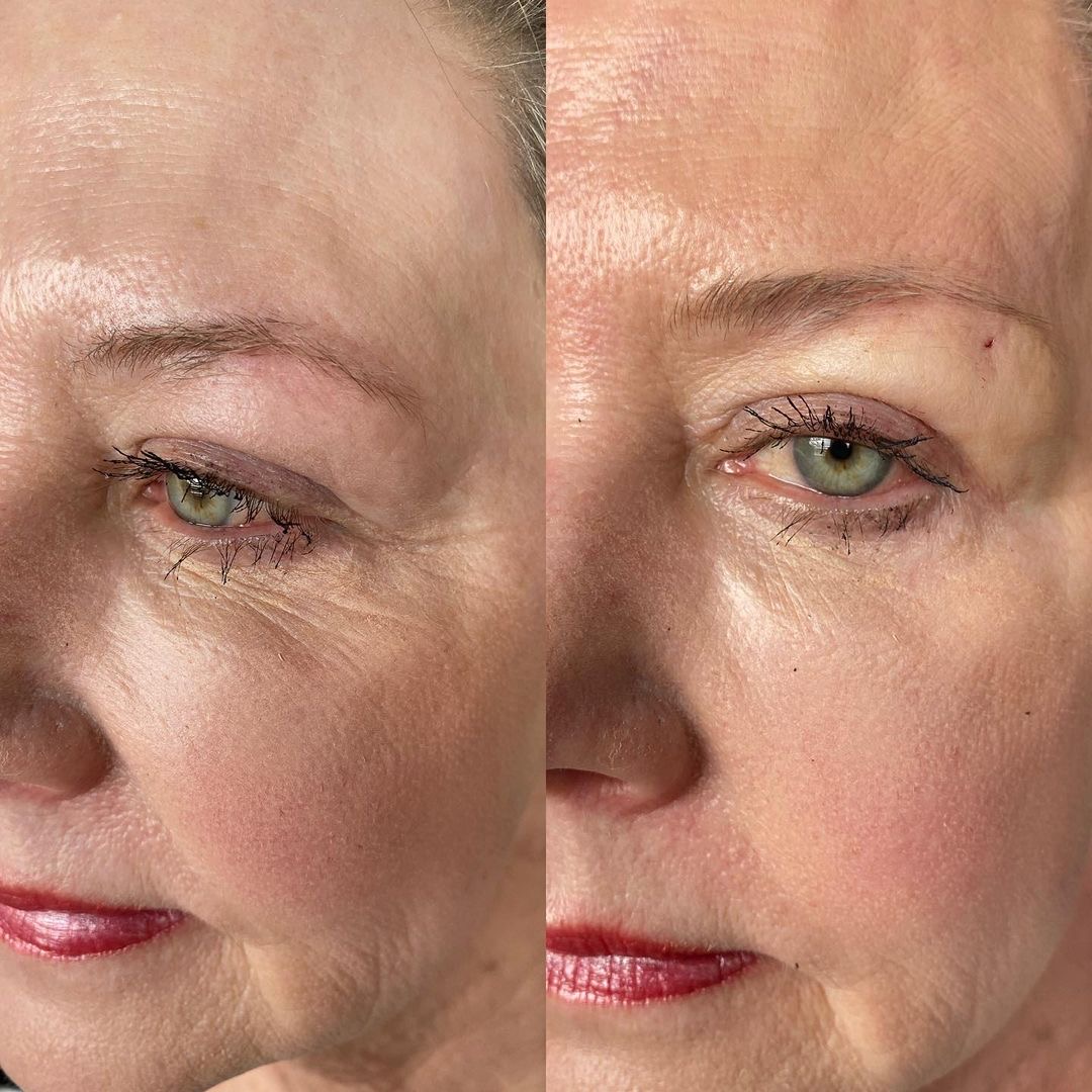Thread Lift - Vitality Antiaging Center